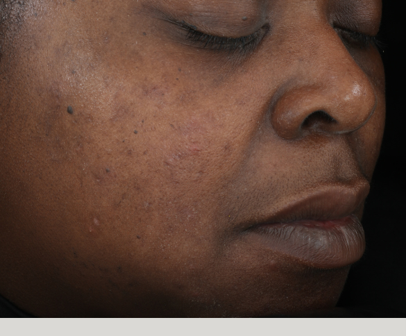 Acne Clarifying Treatment | SkinMedica®